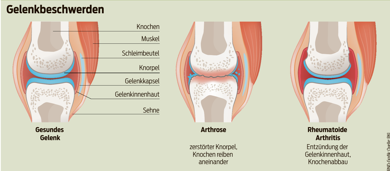 Bei Arthrose spielt Genetik eine Rolle - Gesundheit - Magdeburger ...
